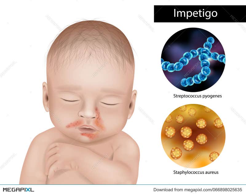 Impetigo Clipart And Illustrations