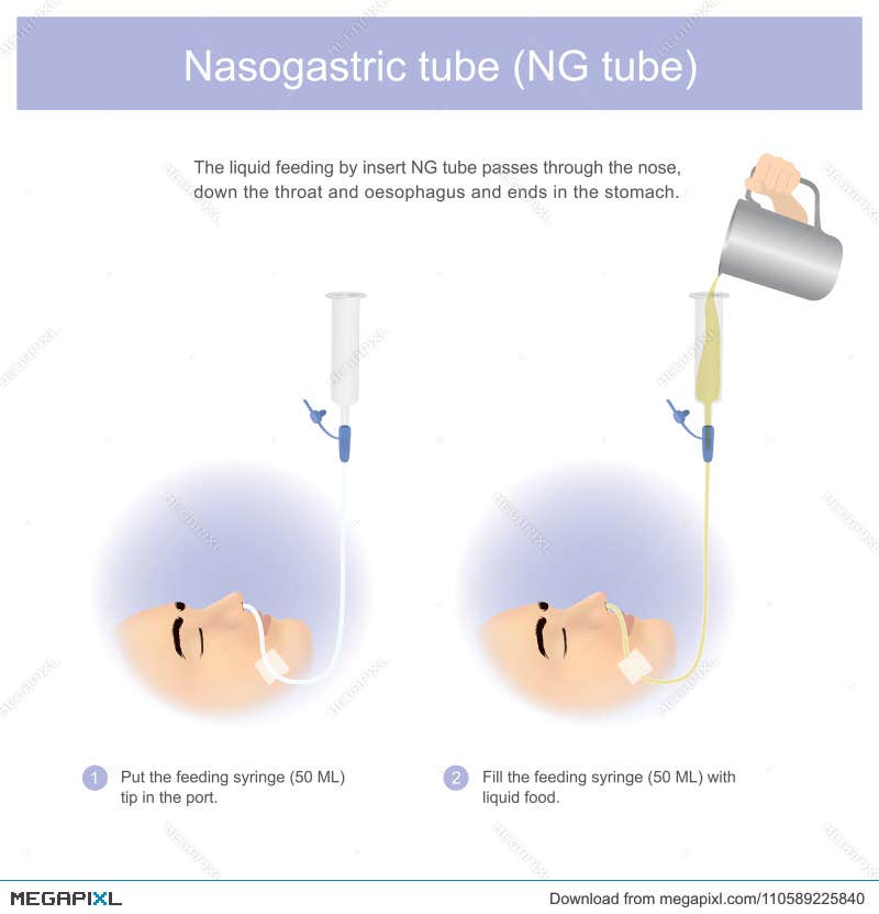 Nasogastric Tube Liquid Feeding Insert Ng Tube Passes Th Clipart And ...