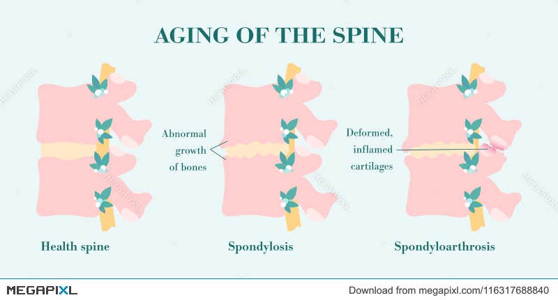 Spondylopathy Clipart And Illustrations