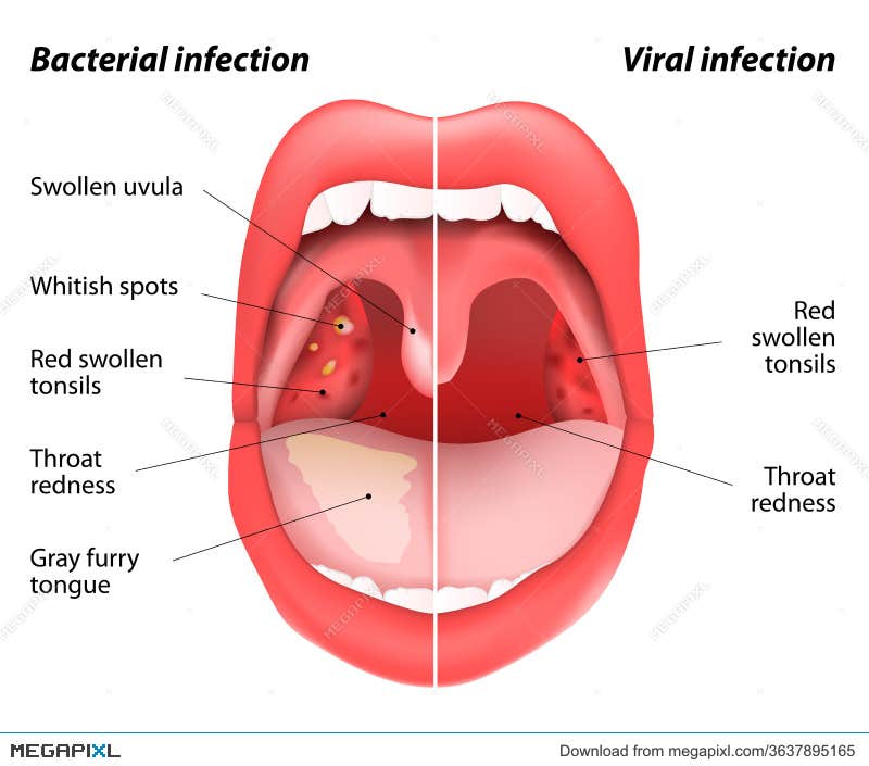 Bacterial Infection Disease Tongue Stock Images By Megapixl