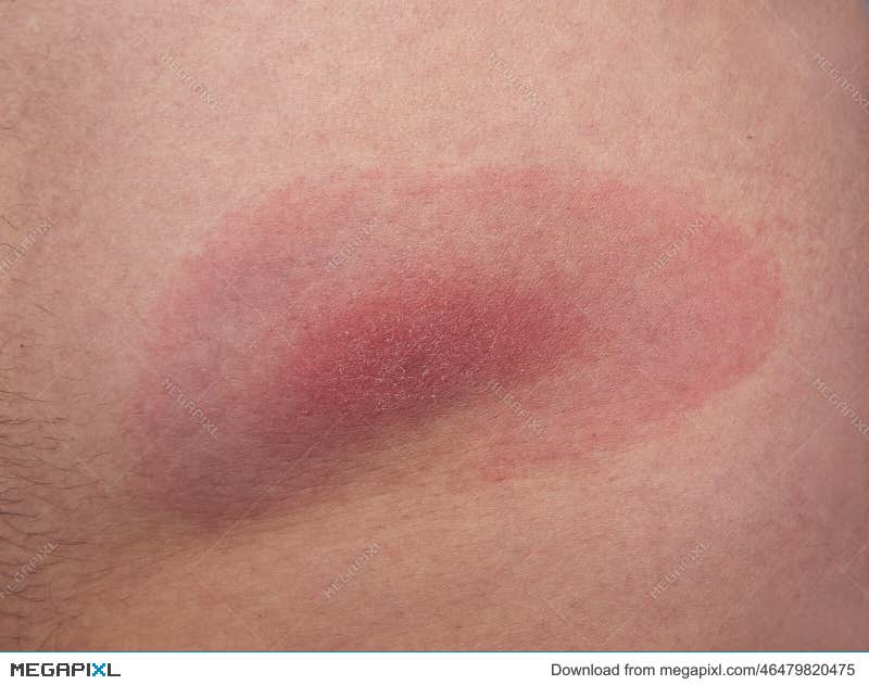 Lyme Borreliosis Erythema Migrans Stock Images by Megapixl