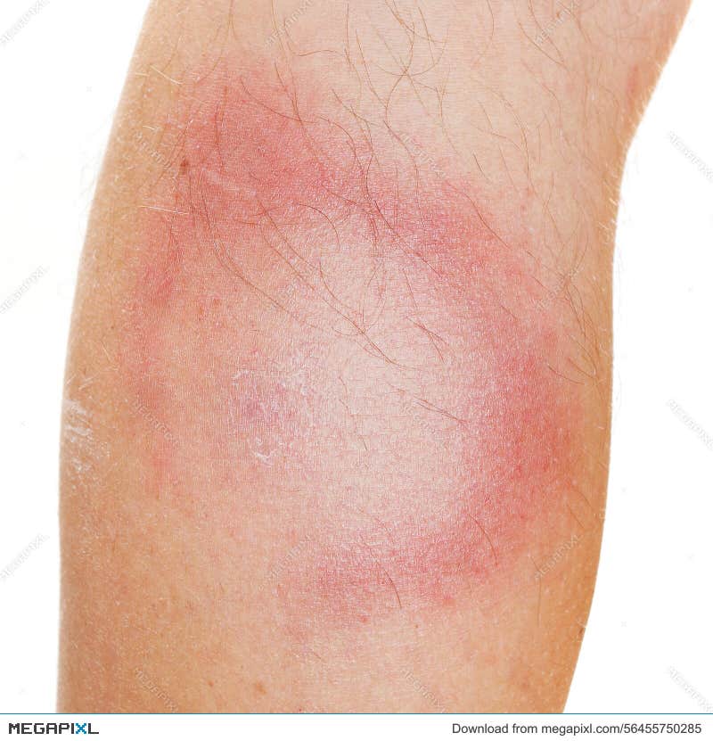 Erythema Migrans Rash Stock Images by Megapixl