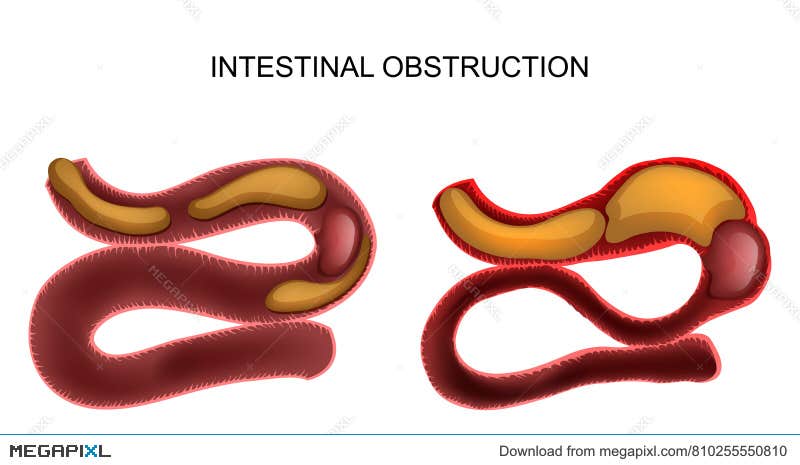 Ileus Clipart And Illustrations