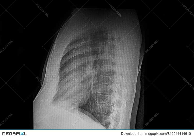 Pectus Excavatum Sunken Chest Stock Images by Megapixl