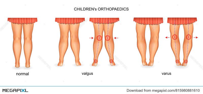 Clubfoot Clipart And Illustrations