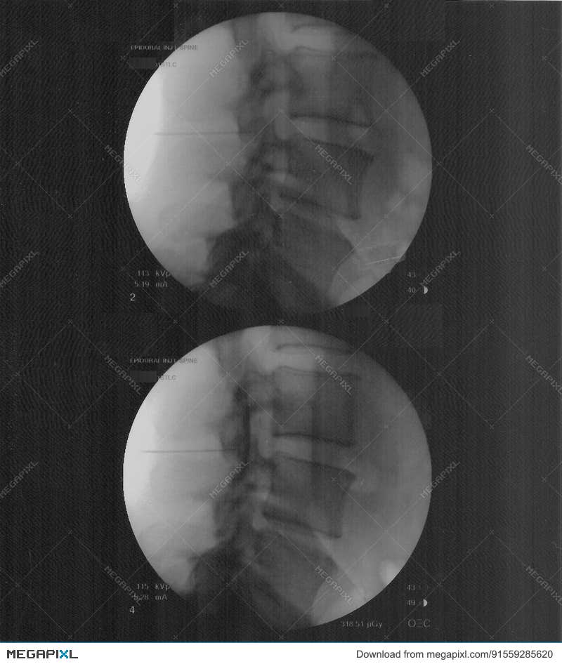 Lateral Epidural Injection Stock Images by Megapixl