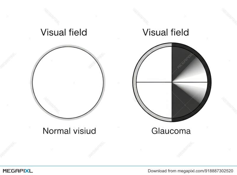 Comparison Chart Eyes Glaucoma Clipart And Illustrations