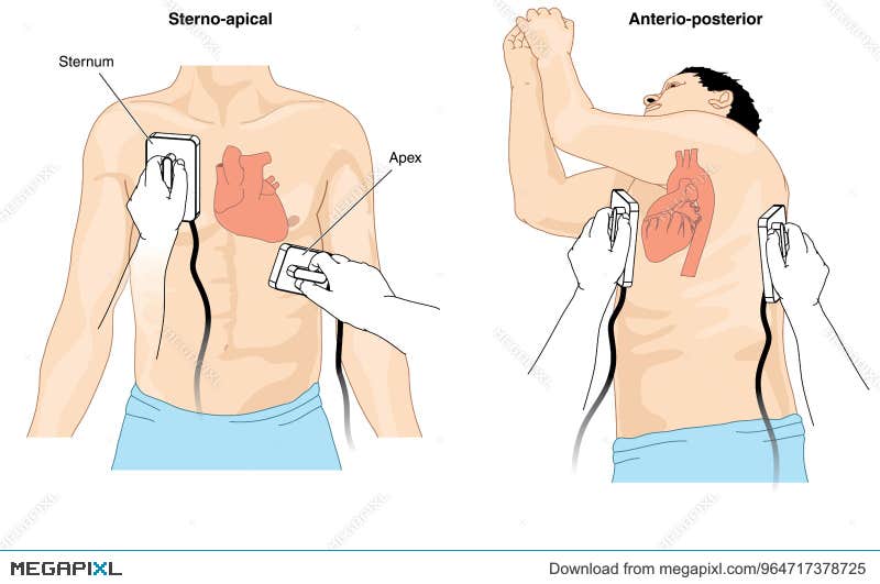 Cardioversion Clipart And Illustrations